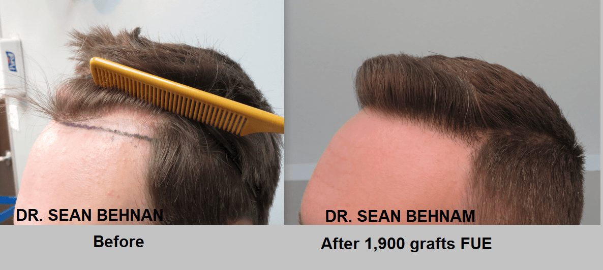 FUE Hair Transplant Los Angeles - Dr. Sean Behnam